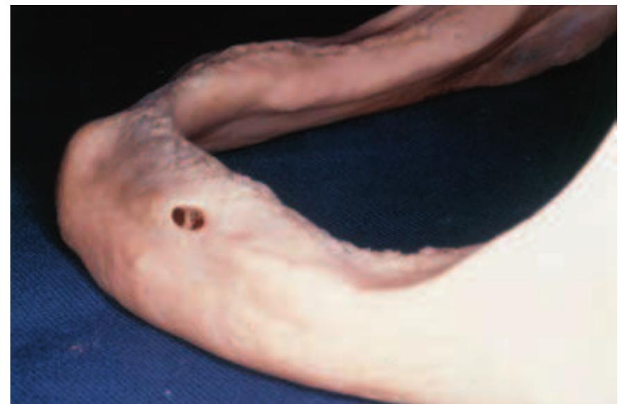 Lateral view of an edentulous mandible. the anterior bone