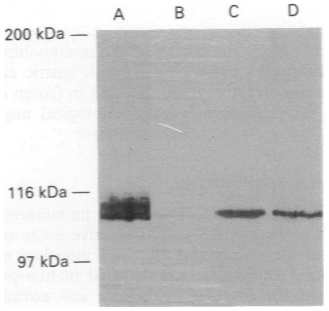 Western blot analysis of prb in a gastric carcinoma of the