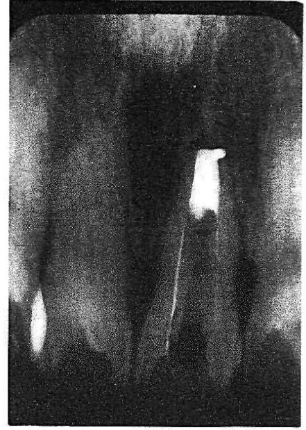 Segmental placement and condensation of gutta-percha in