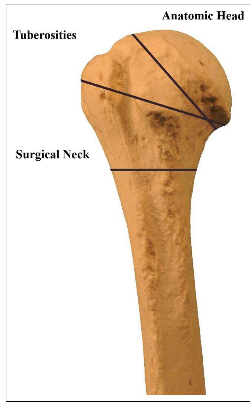 The common zones of injury in the humerus: the anatomic
