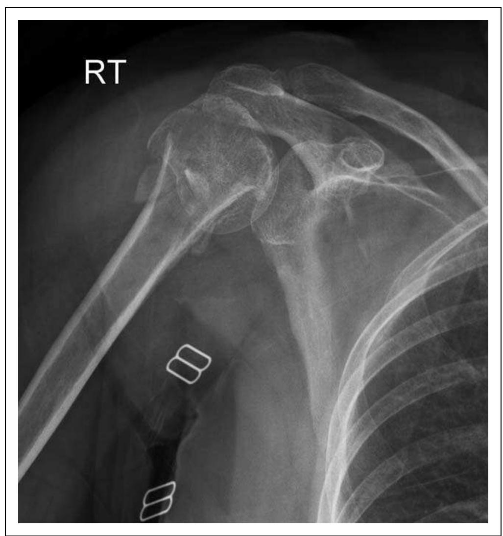 This conventional anteroposterior radiograph shows a