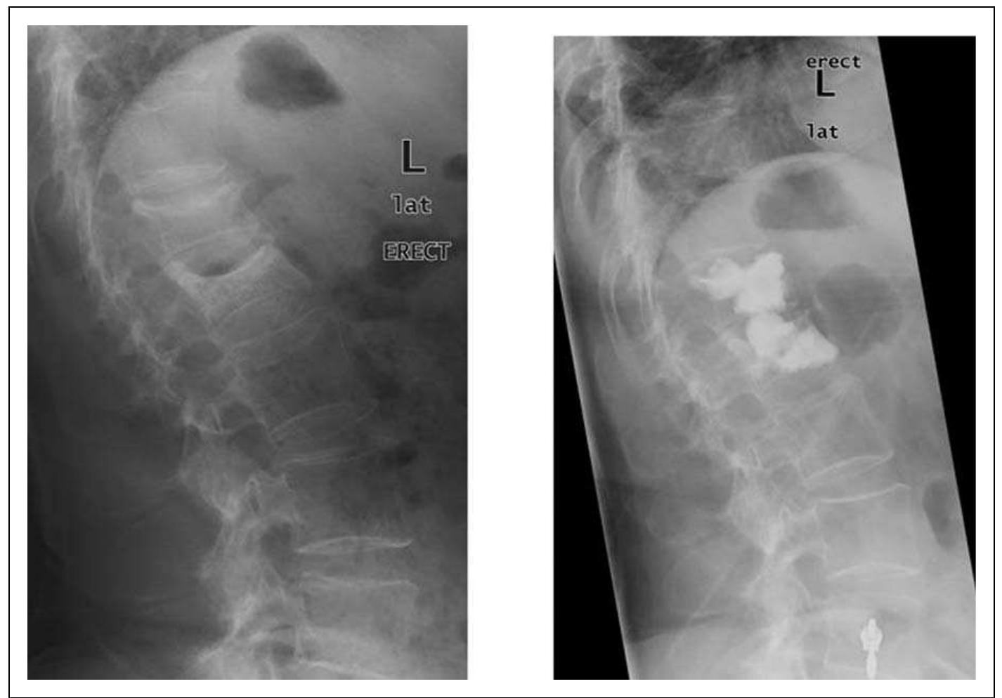 | 1. these conventional lateral radiographs show vertebral