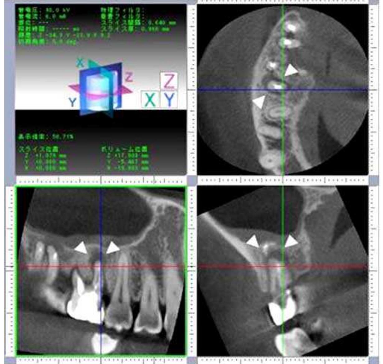 (4). cbct shows the 3d depiction of periodontal bone loss