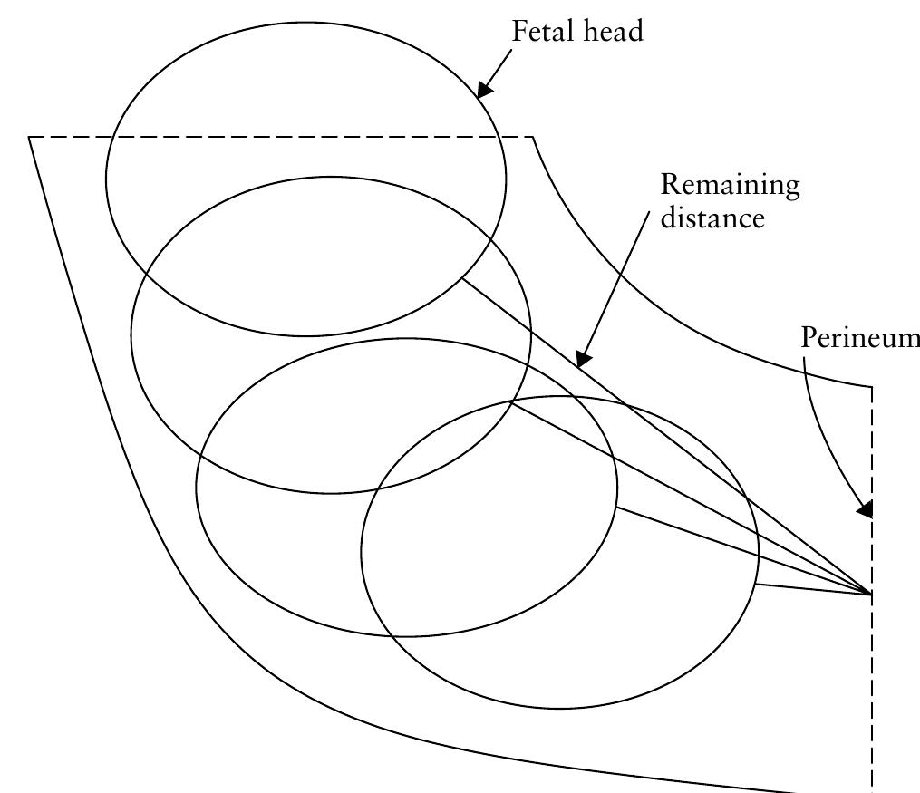 Schematic drawing of fetal head descent in a curved birth
