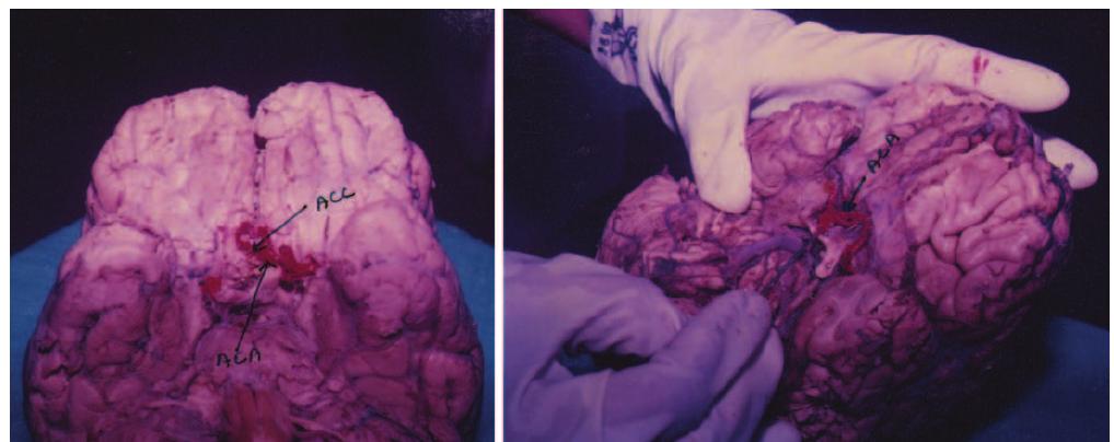 -1: proximal segment of right anterior cerebral artery (aca)