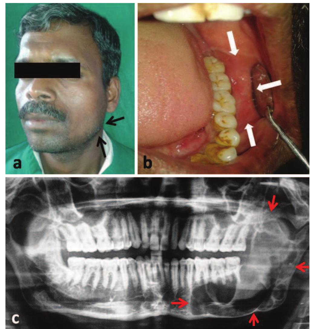 -1: clinical presentation of lesion; (a) diffuse swelling