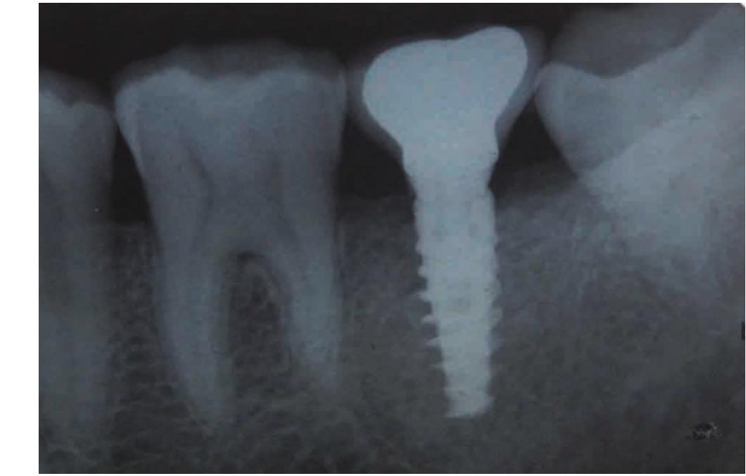 -4: follow-up iopa of the implant with prosthesis