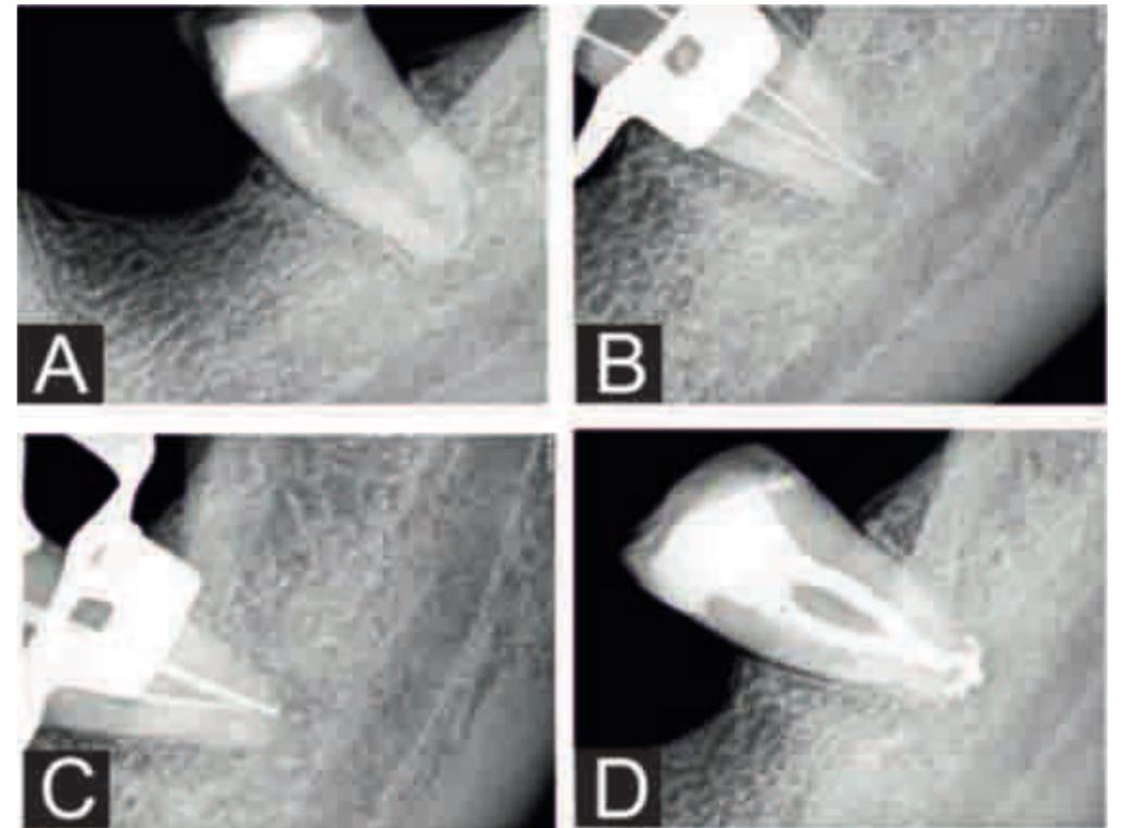-3: (a) preoperative radiograph, (b) working length radio-