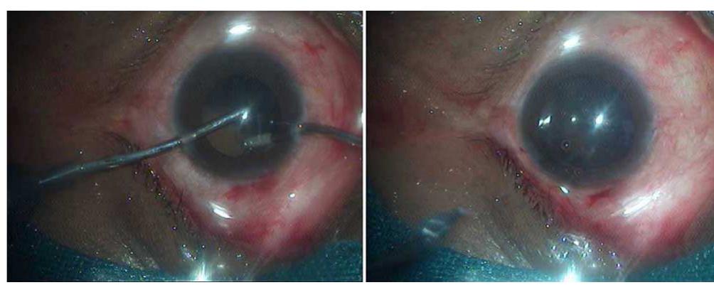 -3: aspiration of cortical fibers at 12 o’clock; figure-4: