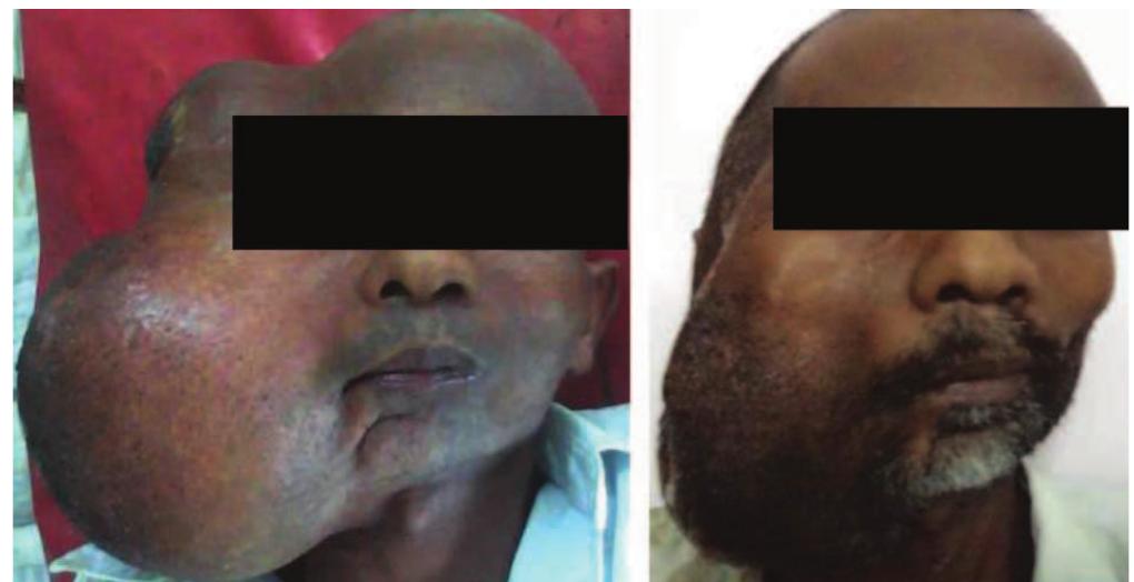 -3: avm of scalp with ulcer of patient no. 3; figure-4: