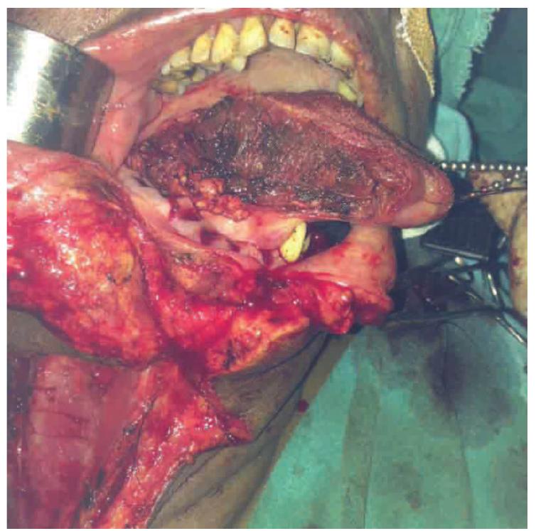 -3: exposure following modified lip splitting incision