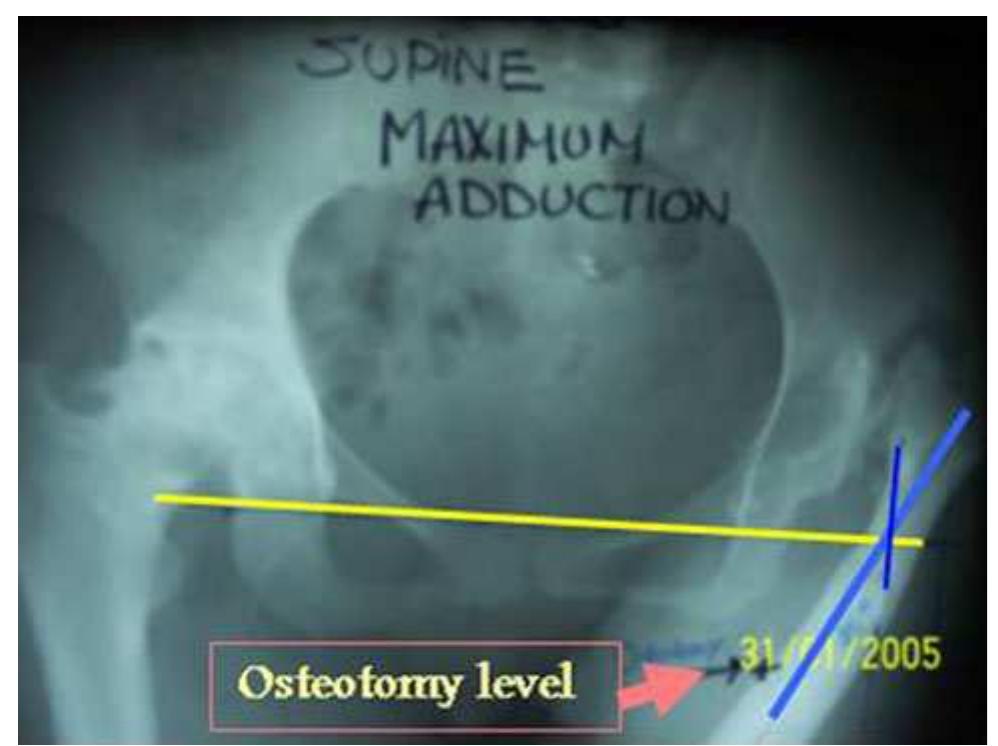 Maximum adduction cross-legged supine radiograph