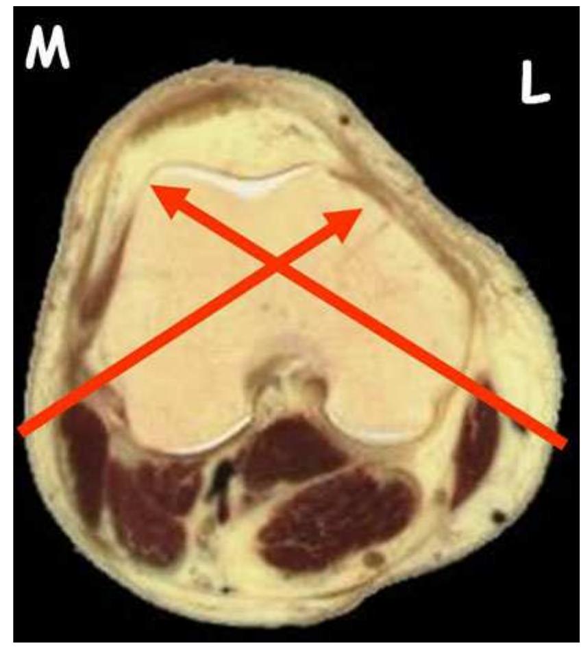 Stable delta configuration of the most distal fixation the