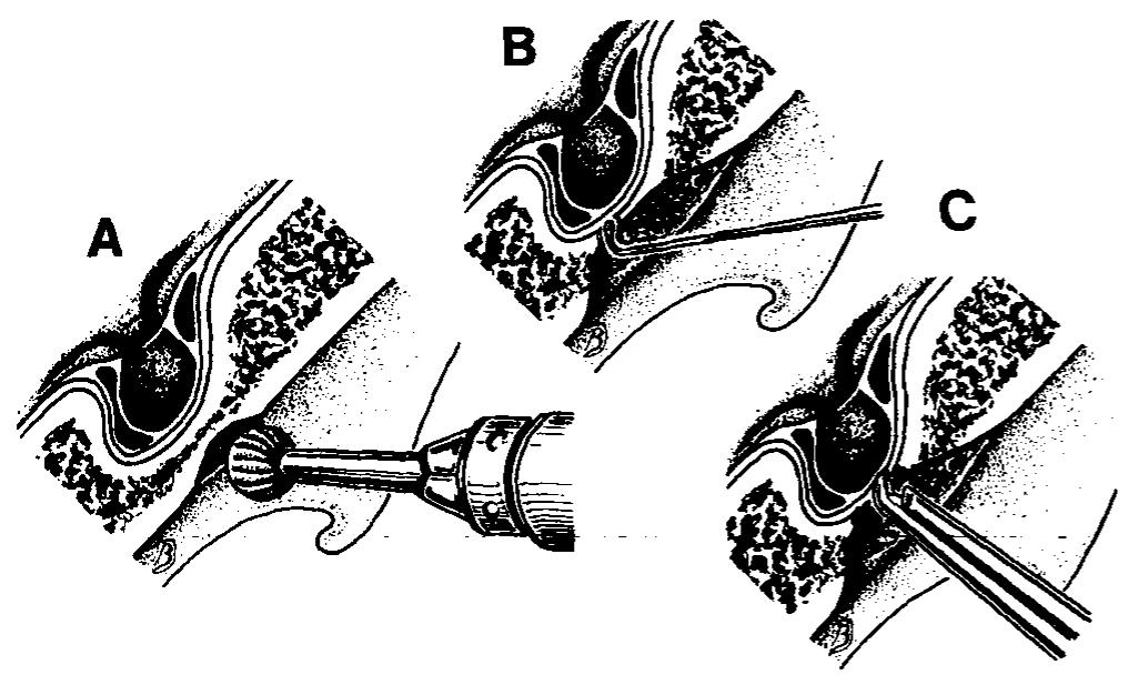 Midsagittal cross-section through the sphenoid bone and the