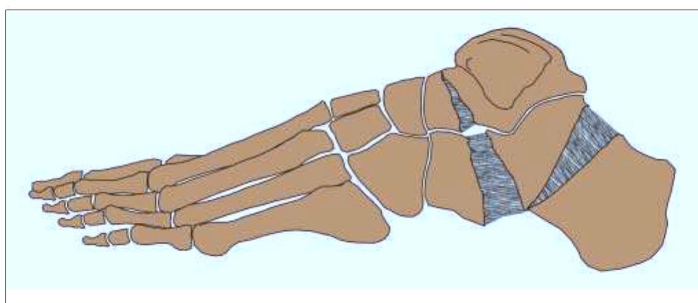 Figure 10 - Correction of complex foot deformities using the