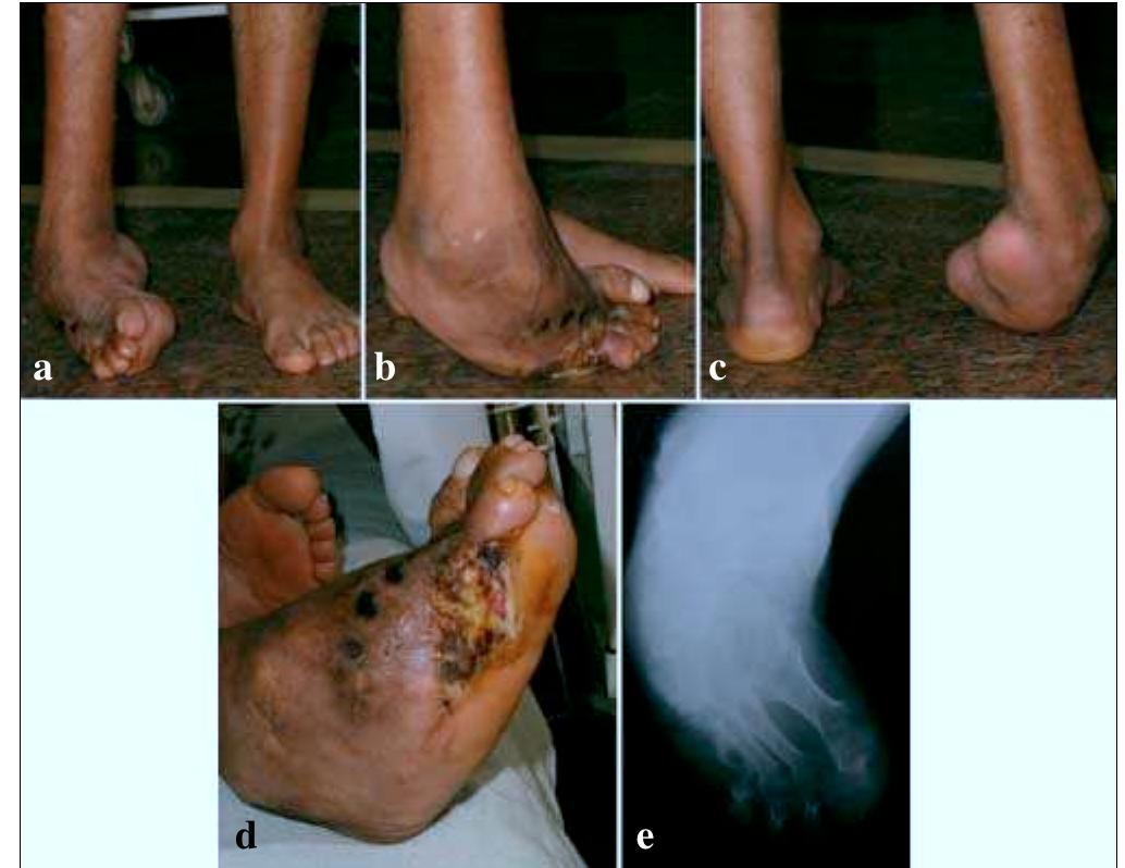 Clinical photographs (a—d) and x-rays (e) showing a 27-