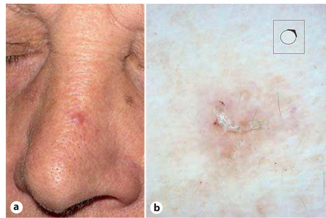 Tungiasis fig. 4. a unusual clinical presentation of scabies
