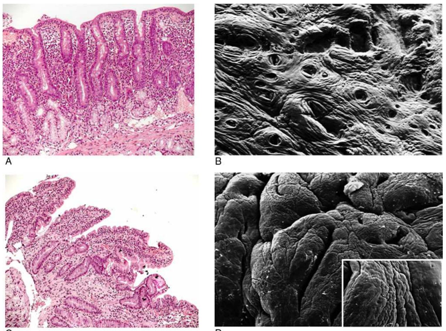 |. a. histologic picture of duodenal mucosa showing total