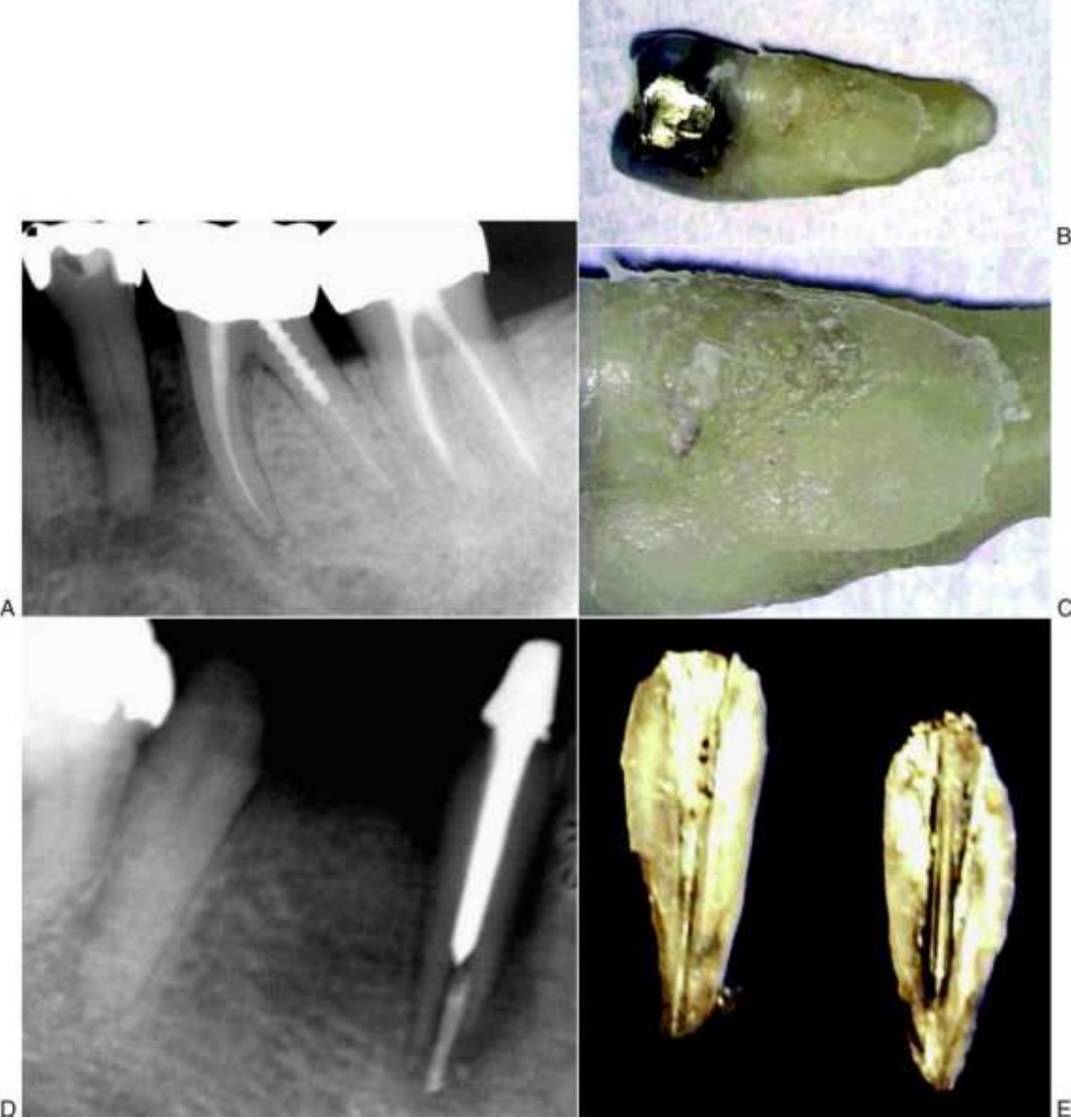-26 poorly fitting intracoronal restorations can place
