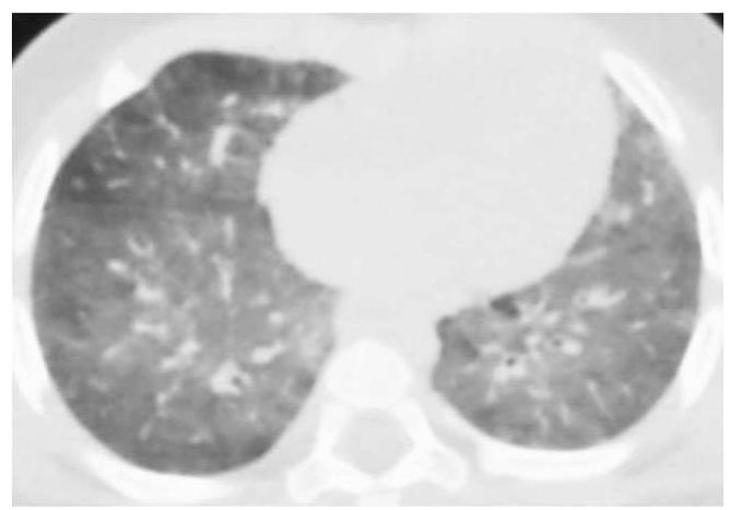Postmortem axial chest ct shows normal pulmonary edema in a