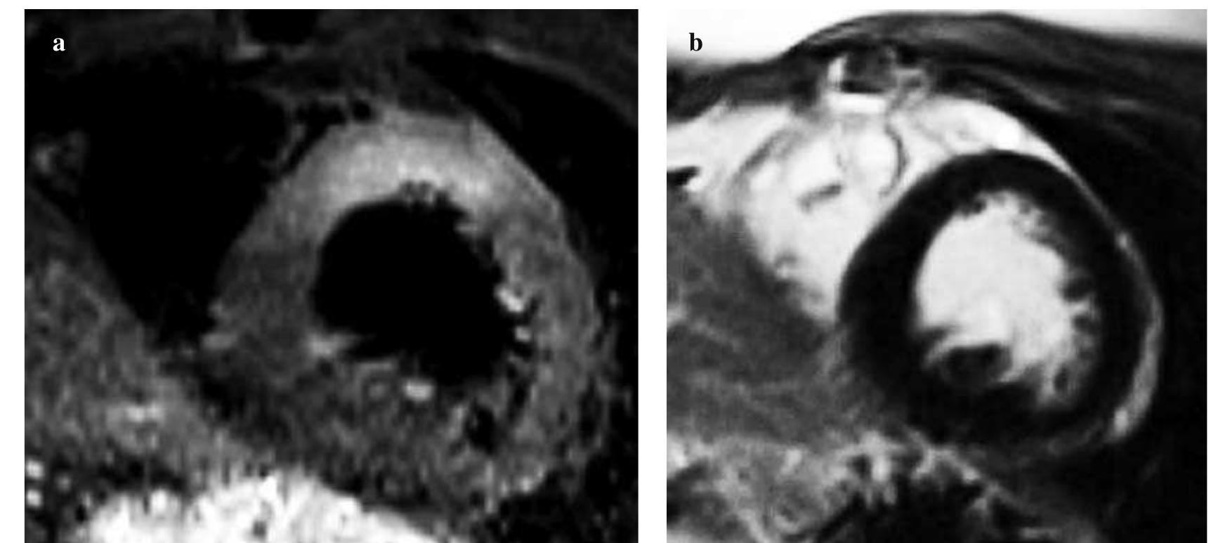 A,b aborted, acute, anteroseptal mi. in this 57-year-old