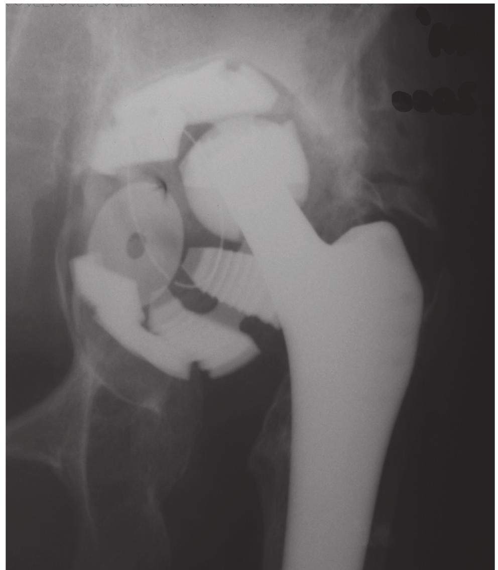 Figure 2 - Burch-schneider cage fracture: a case report