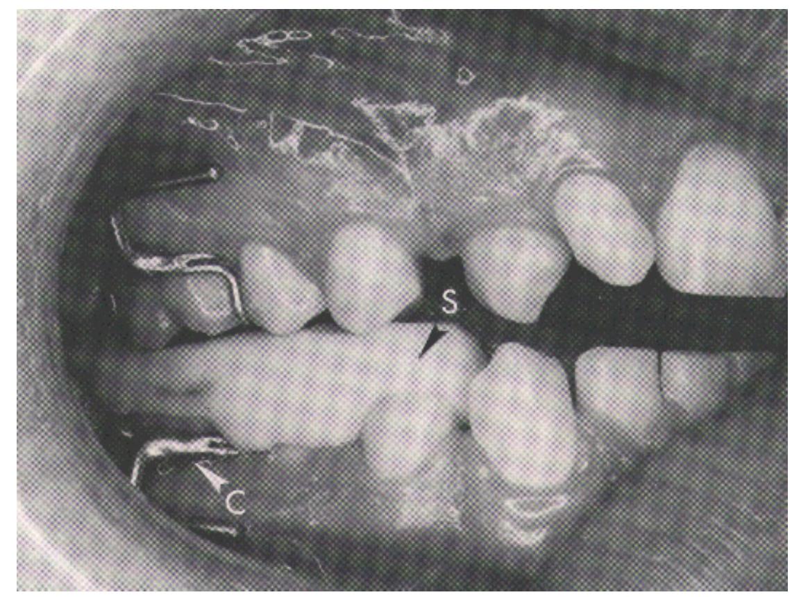 A plastic posterior splint (s) was fabricated by adding cold