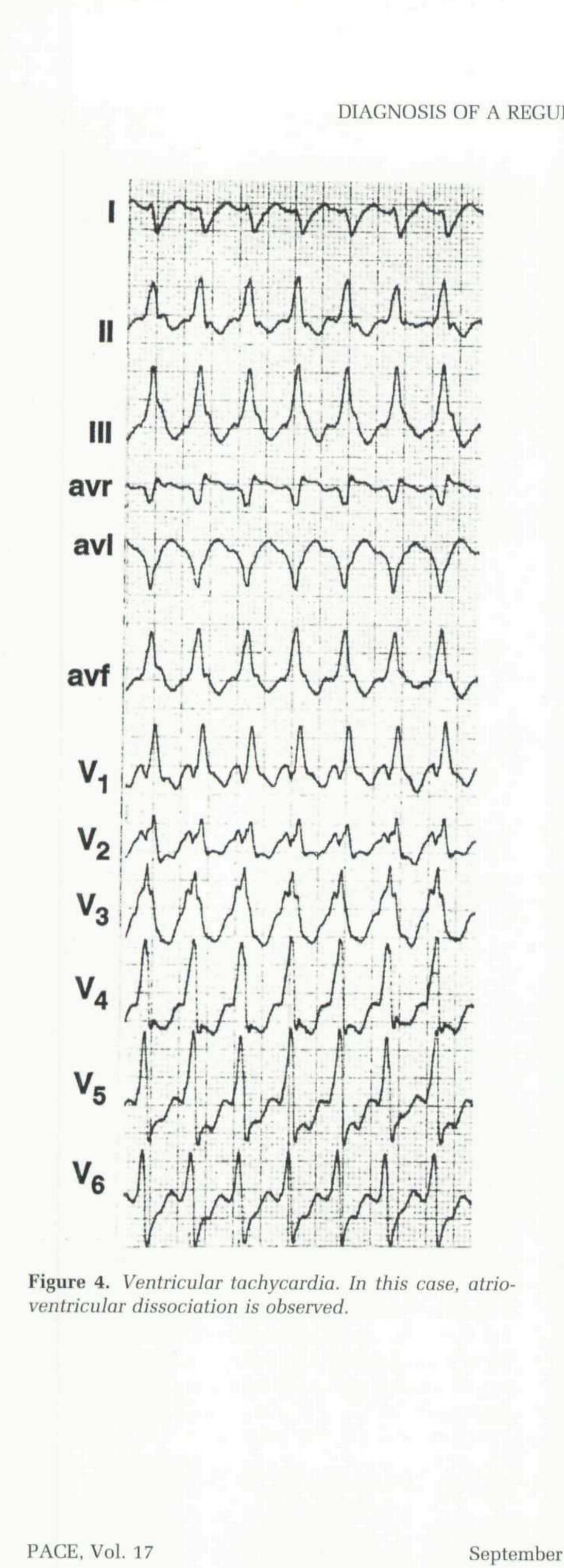 Figure 2 - The Differential Diagnosis of a Regular