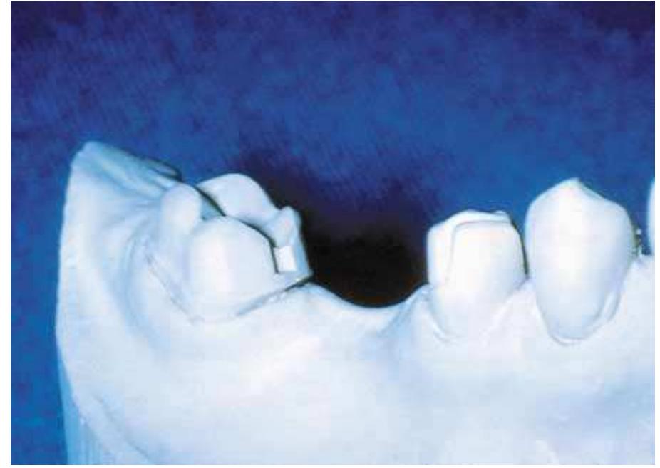 Cast of mandibular molar retainer tooth preparation
