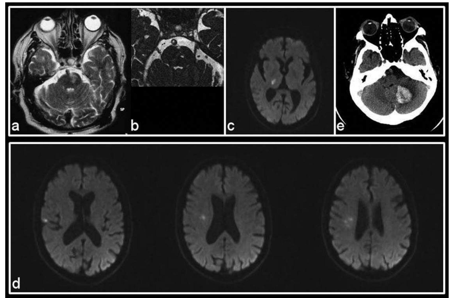 Patient 1: t2-mri acute stage (a) and 10 months later (b);
