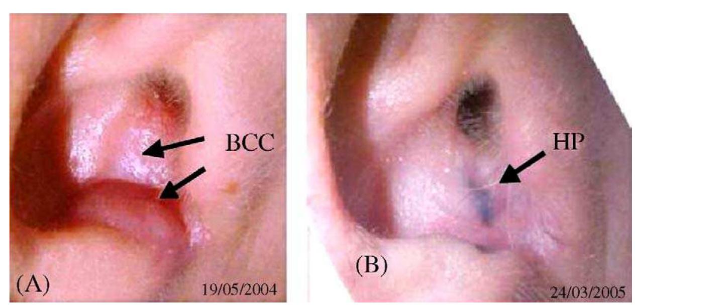 P.h.g.c., male, 37-year-old, with a basal cell carcinoma