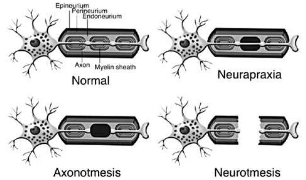 Classification of peripheral nerve injury figure 1.