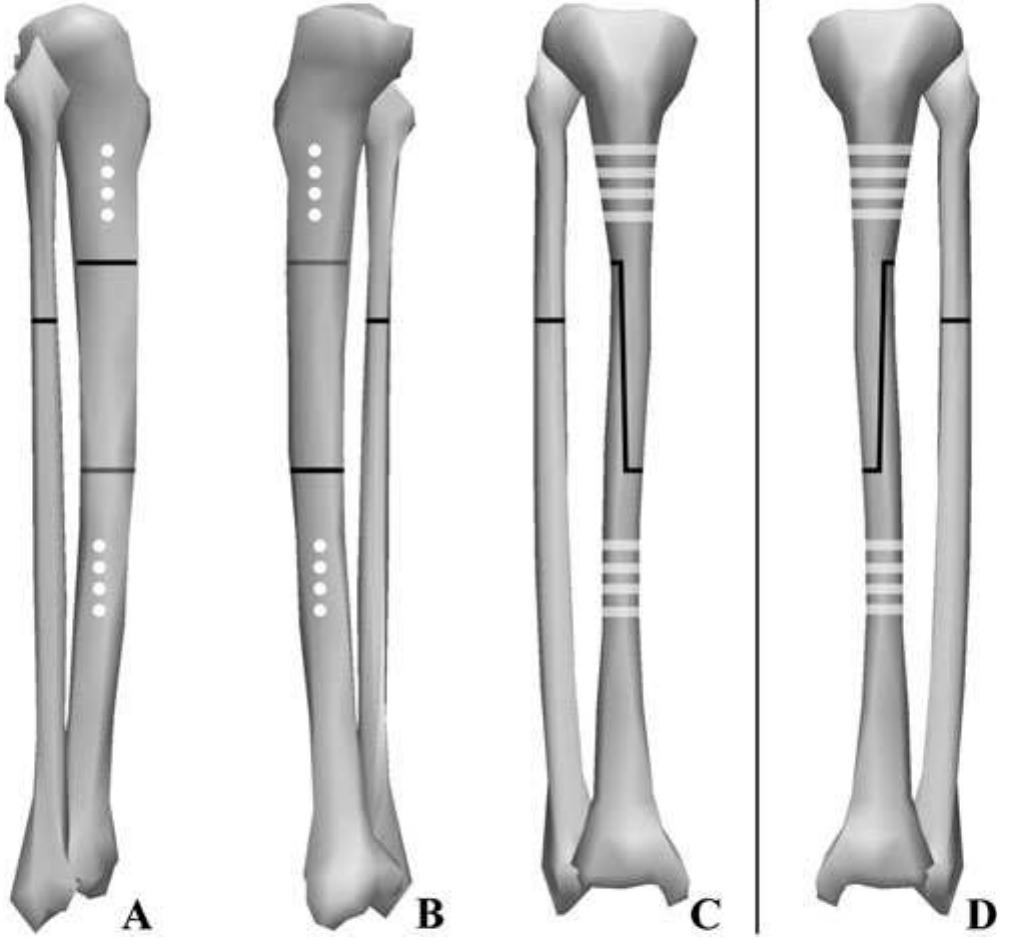 S-z osteotomy in a right tibia. a lateral view demonstrates