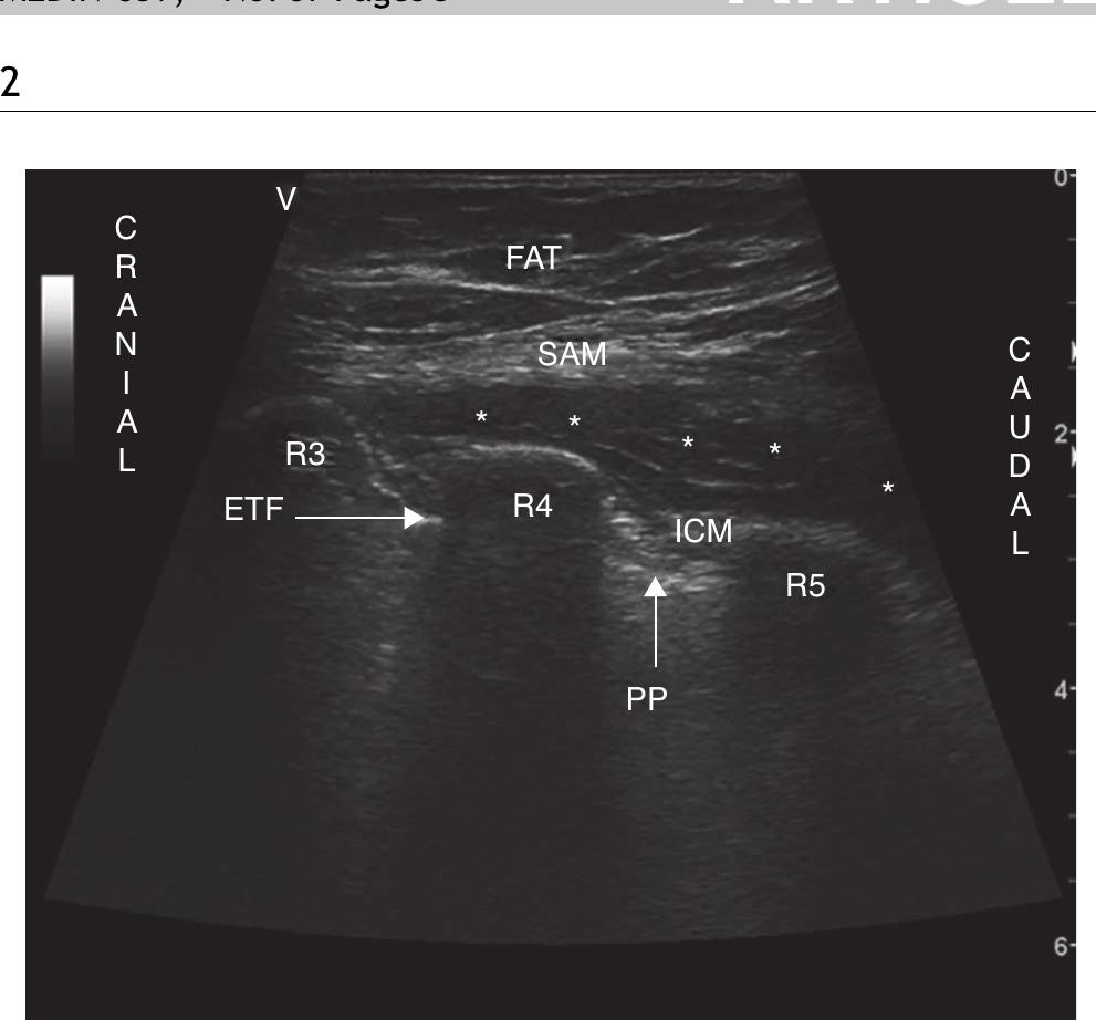 ultrasound of the chest wall showing the planes visu-