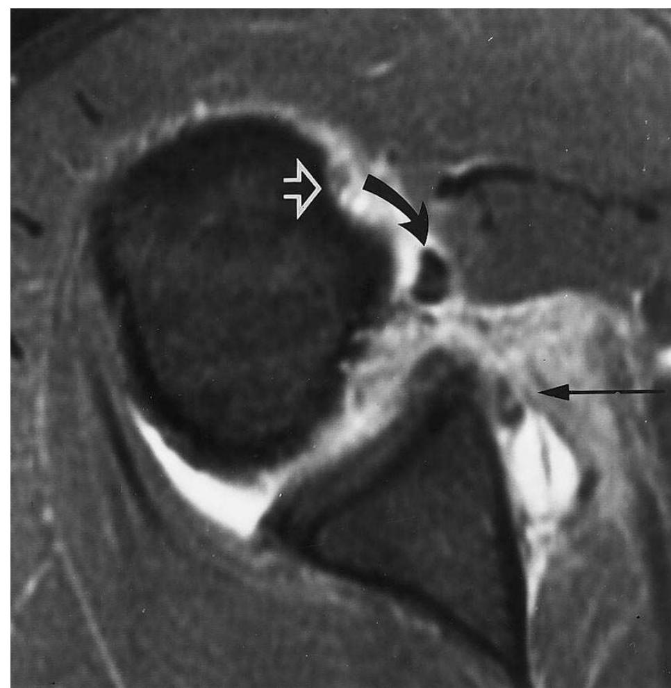 - subscapularis tear with dislocation of biceps tendon.