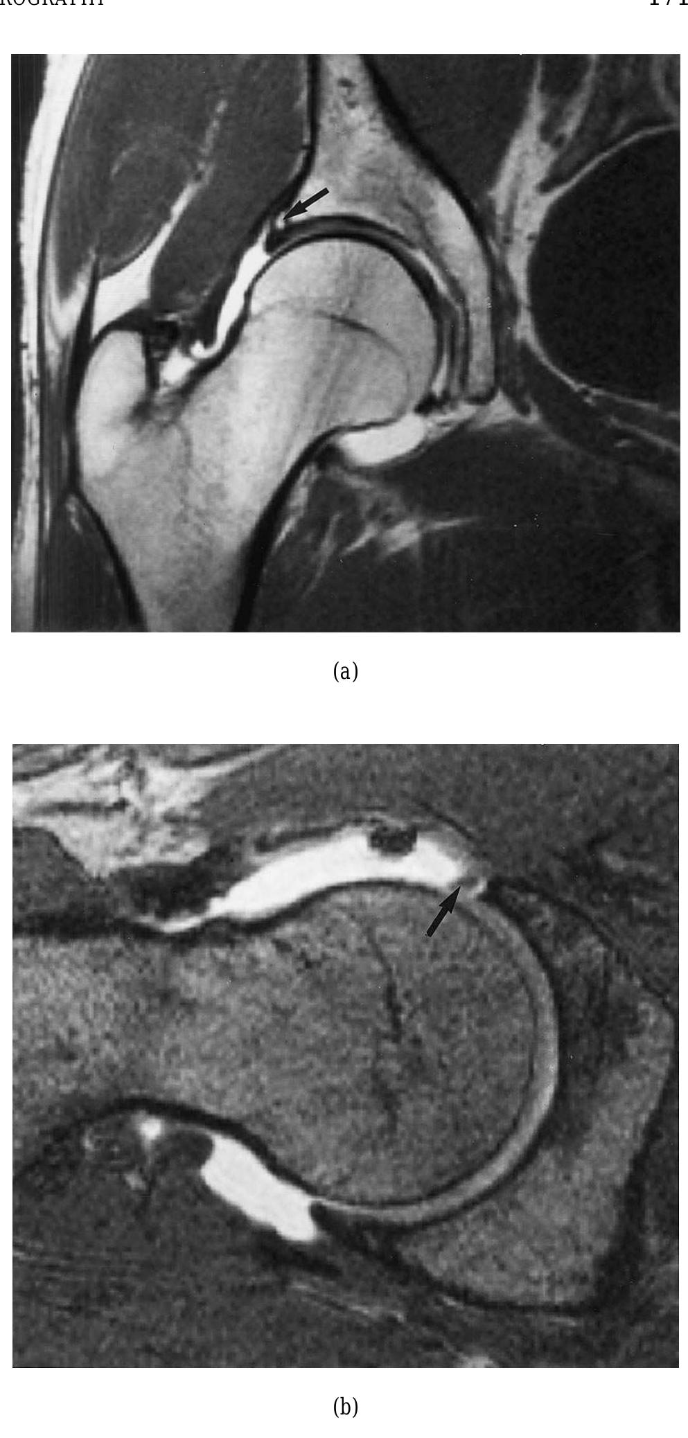 - early acetabular labral cyst formation. (a) a small