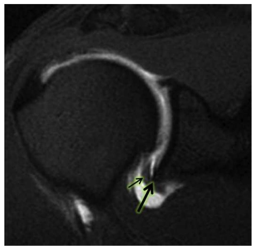 Double axillary pouch sign, anterior labral tear in the