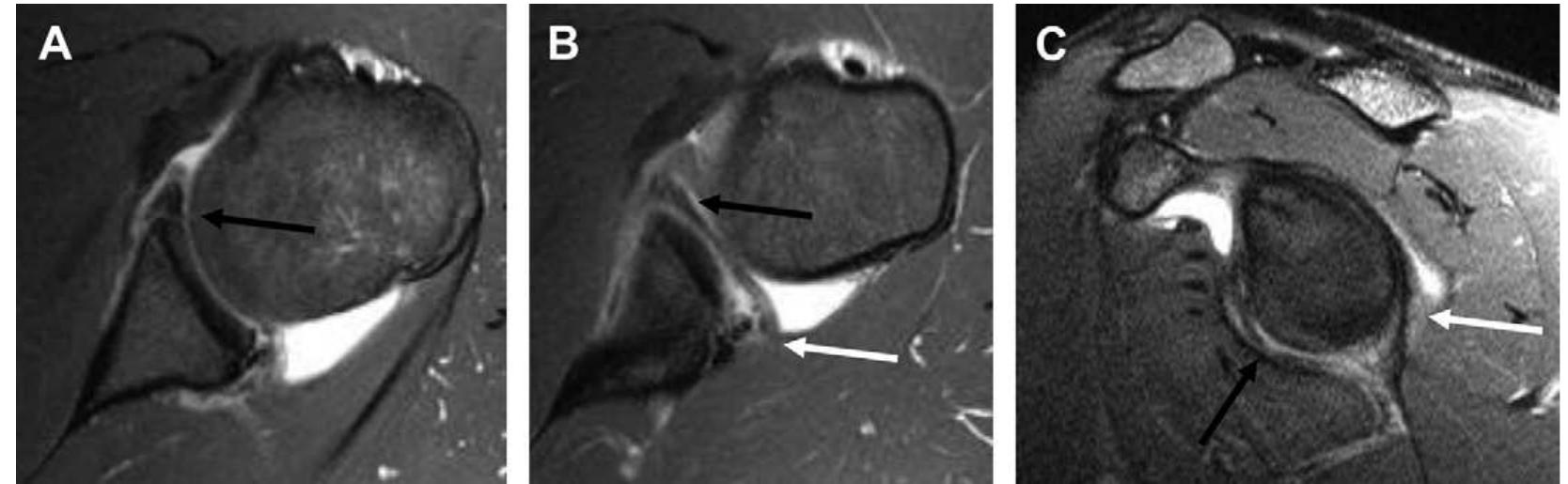 Tear of the inferior labrum anterior and posterior. indirect
