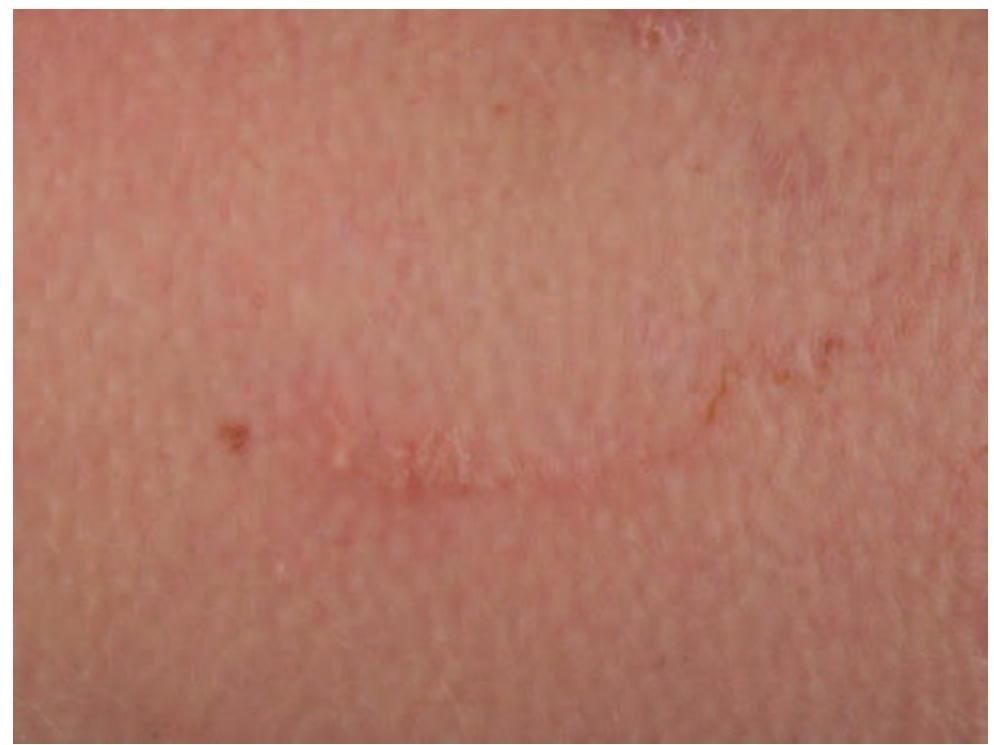 Serpiginous track of cutaneous larva migrans with only