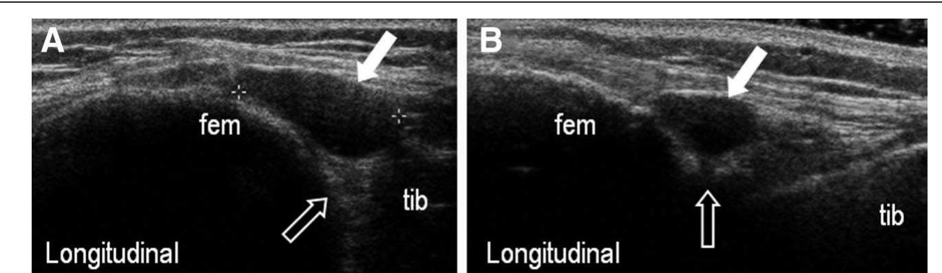 A, longitudinal sonogram across the lateral joint line of