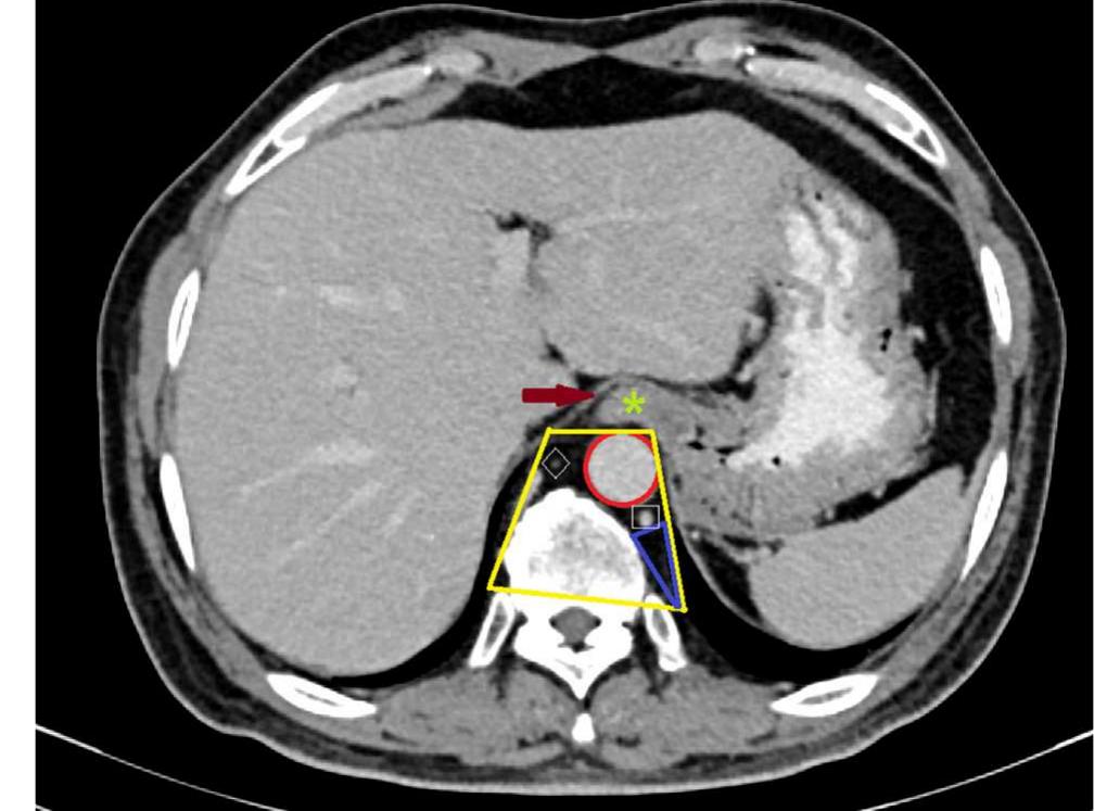 Radiologic anatomy of esophageal hiatus and retrocrural