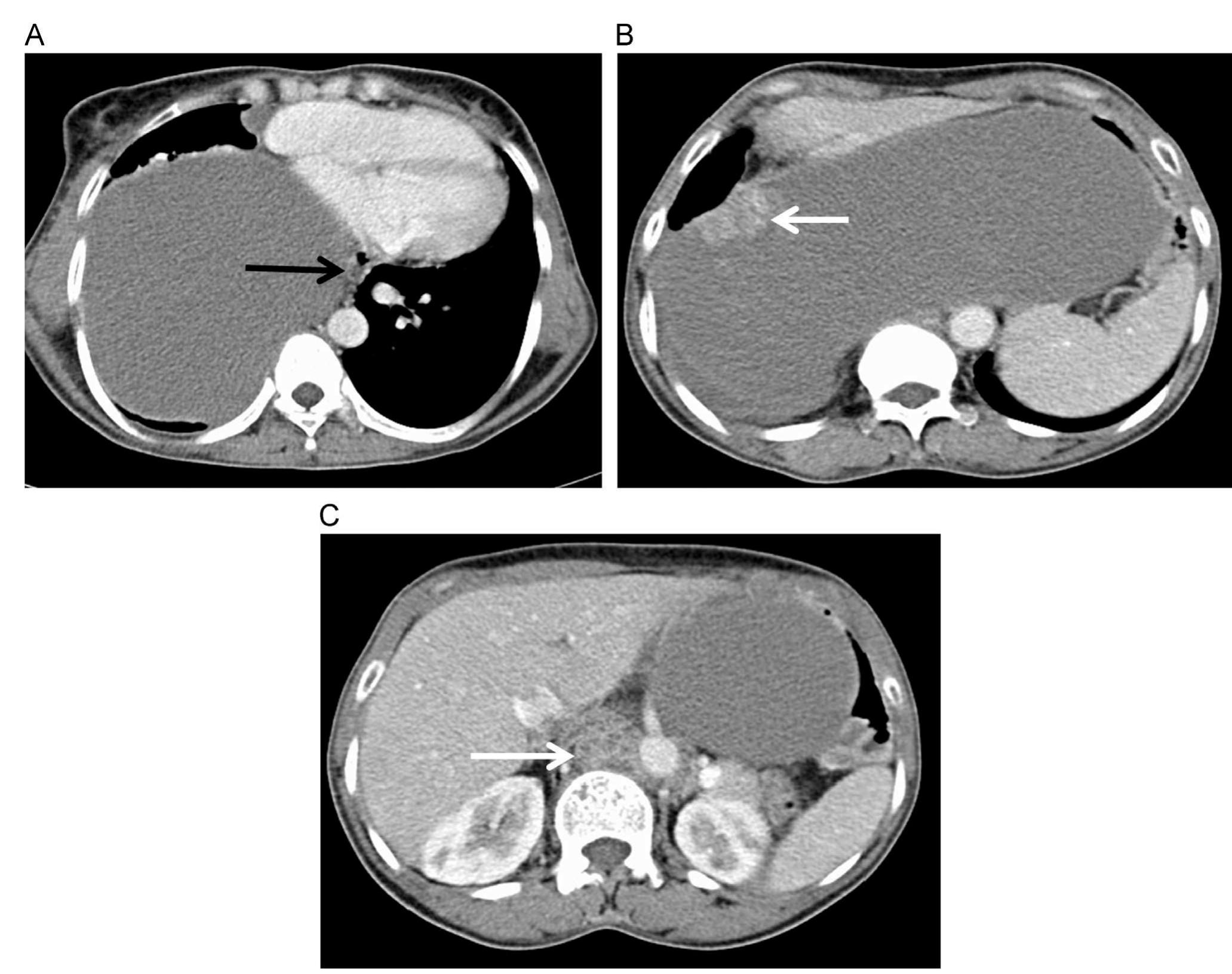 Thoracoabdominal foregut duplication cyst in a 50-year-old