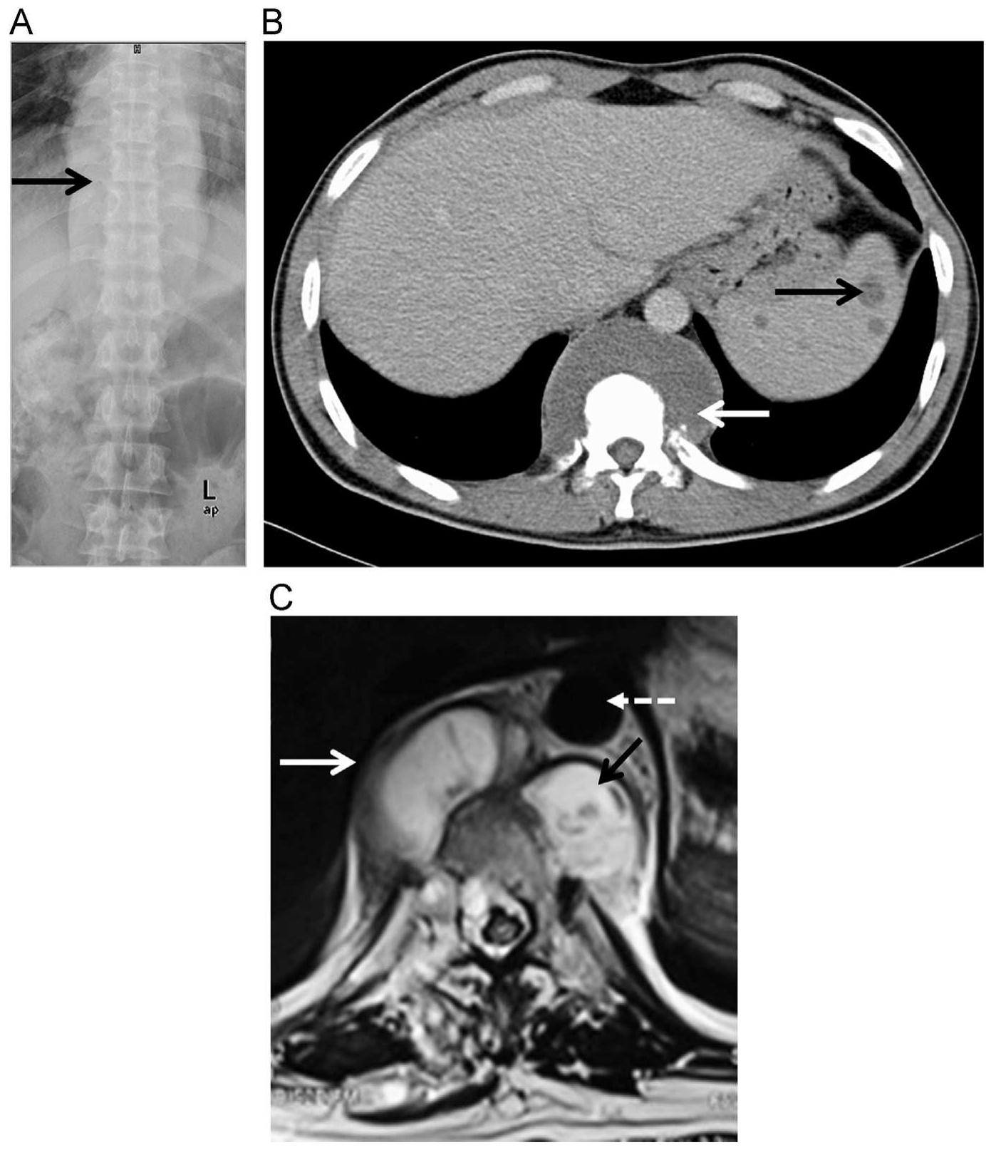 Thoracoabdominal paravertebral tubercular abscess (a)