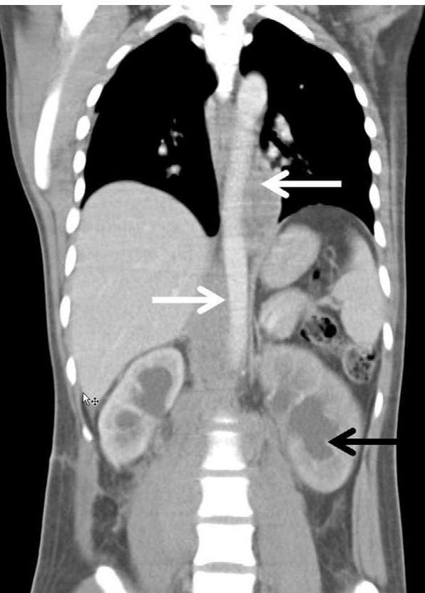 Non-hodgkin's lymphoma in a 50-year-old man. coronal