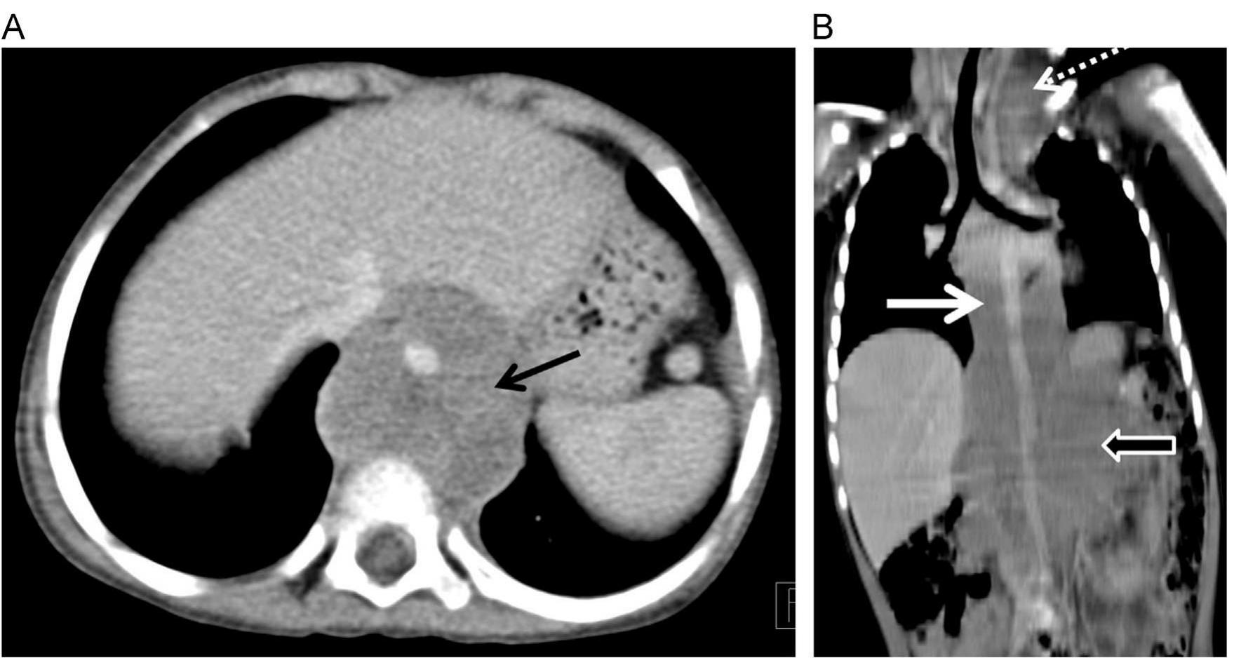 Neuroblastoma with retrocrural extension in a 1-year-old