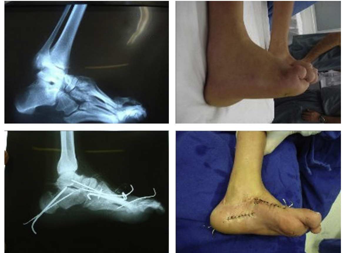 Samilson osteotomy for calcaneocavus foot. cole osteotomy of