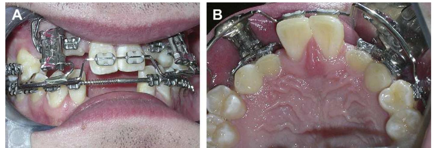 (a) anterior view of tooth-borne distraction apparatus to