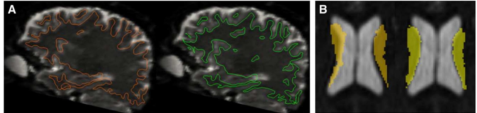 Non-linear registration of t1 csf map to bo csf map.
