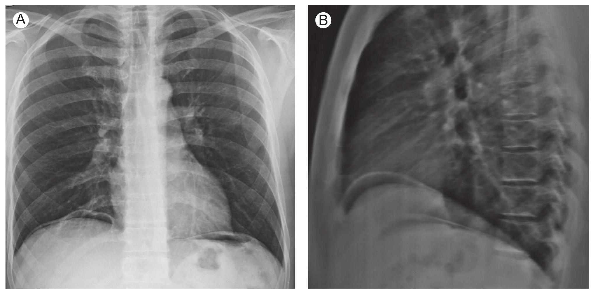 Upright posteroanterior (a) and lateral (b) chest
