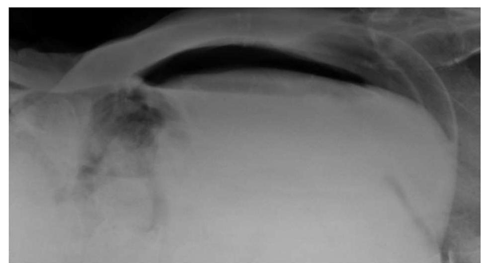 Cross-table lateral abdominal radiograph showing the